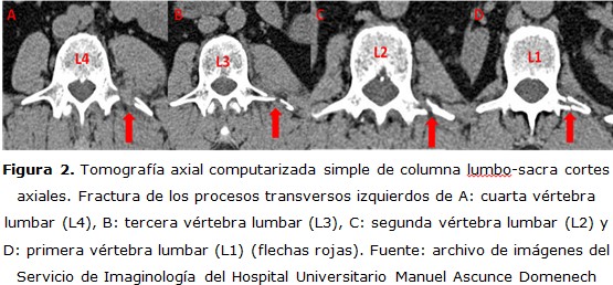 Fracturas de múltiples procesos transversos lumbares contiguos ...
