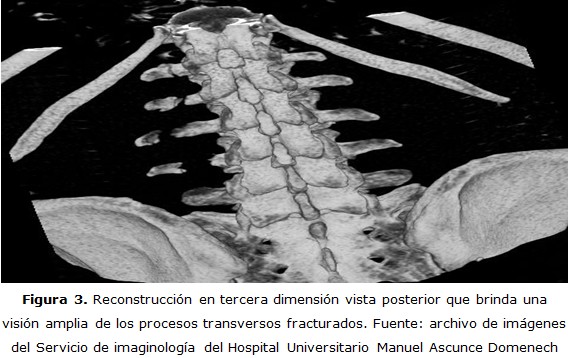 Fracturas de múltiples procesos transversos lumbares contiguos ...