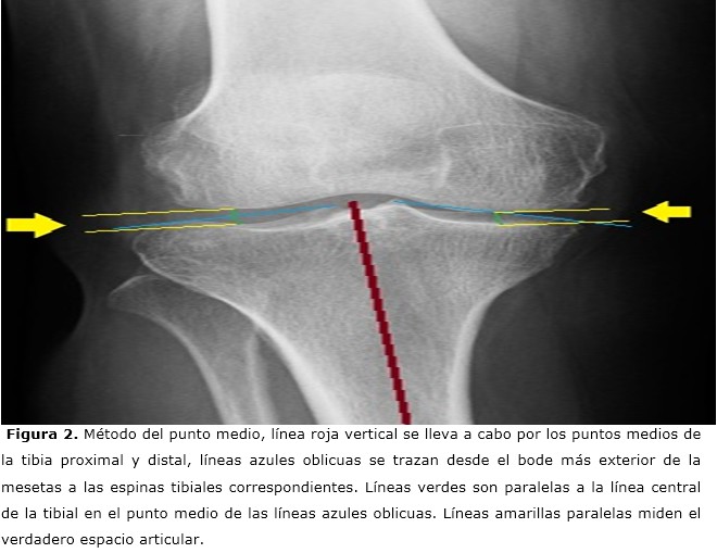 Medición del espacio tibiofemoral | Alvarez-López | Archivo Médico Camagüey