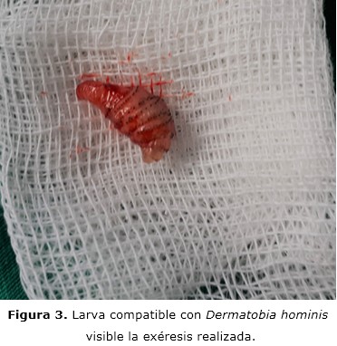 Miasis por Dermatobia hominis: presentación de un caso clínico | García ...