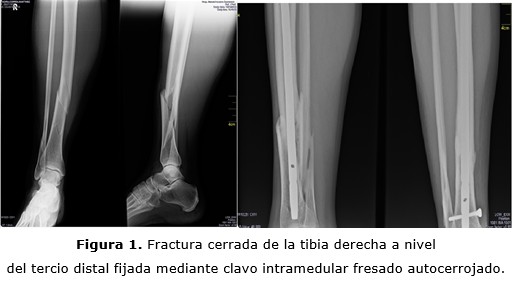 Fracturas diafisarias del tercio distal de la tibia | Alvarez-López ...