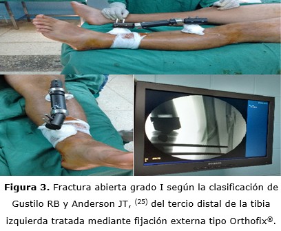 Fracturas diafisarias del tercio distal de la tibia | Alvarez-López ...