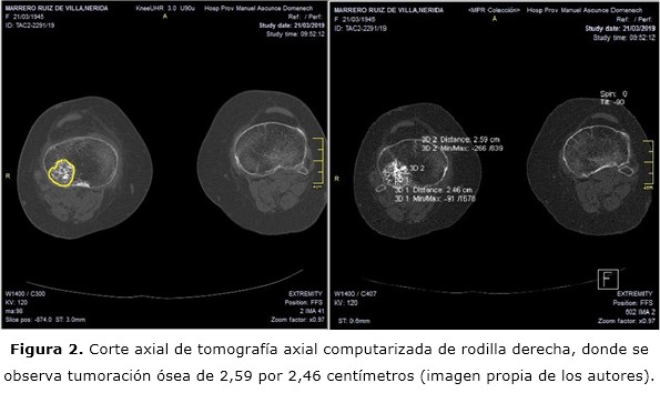 Encondroma: a propósito de un caso | Alvarez-López | Archivo Médico ...