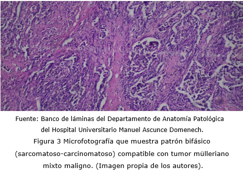 Tumor mülleriano mixto maligno | Piñón-García | Archivo Médico Camagüey