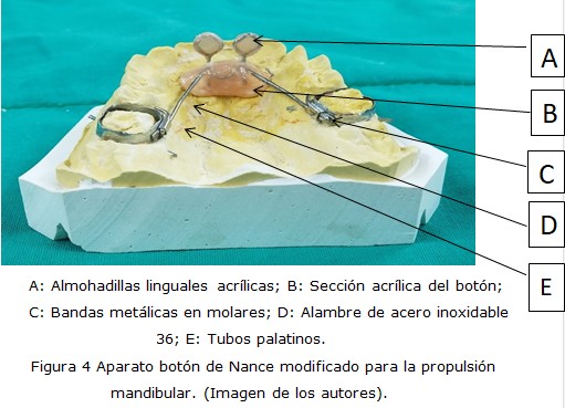 Utilización del botón de Nance modificado para la propulsión mandibular | Leiser Verano-Luis ...
