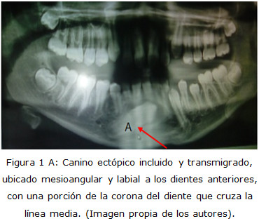 Tratamiento ortodóncico quirúrgico de canino inferior derecho ...