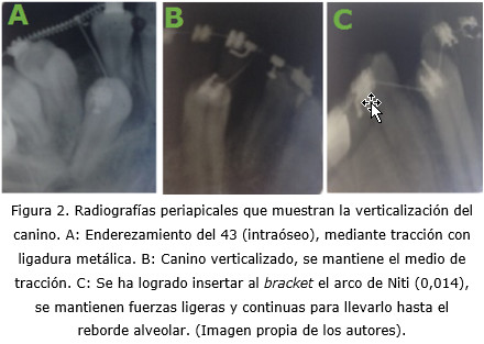 Tratamiento ortodóncico quirúrgico de canino inferior derecho ...