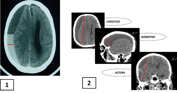 Evaluación multimodal del hematoma subdural crónico | Mosquera ...