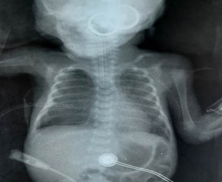 Quilotórax congénito en un recién nacido pretérmino extremo | Rodríguez ...