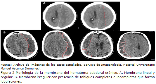 Caracterización tomográfica de las membranas en pacientes con hematoma ...