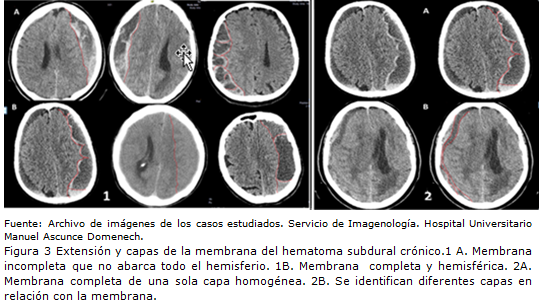 Caracterización tomográfica de las membranas en pacientes con hematoma ...