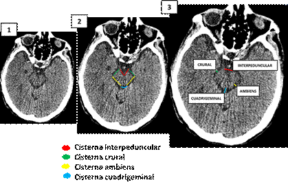 Anatomía De La Cisterna Supraselar