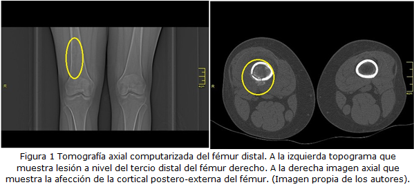Osteomielitis hematógena del fémur en el adulto | Alvarez-López ...