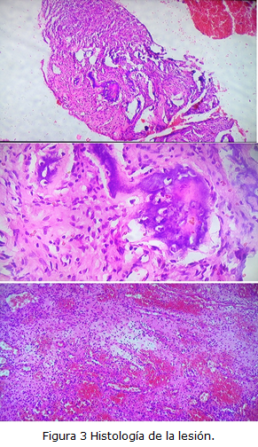 Osteomielitis hematógena del fémur en el adulto | Alvarez-López ...