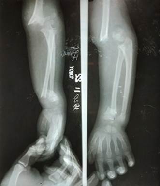 Situaciones transoperatorias en pacientes pediátricos con fractura ...